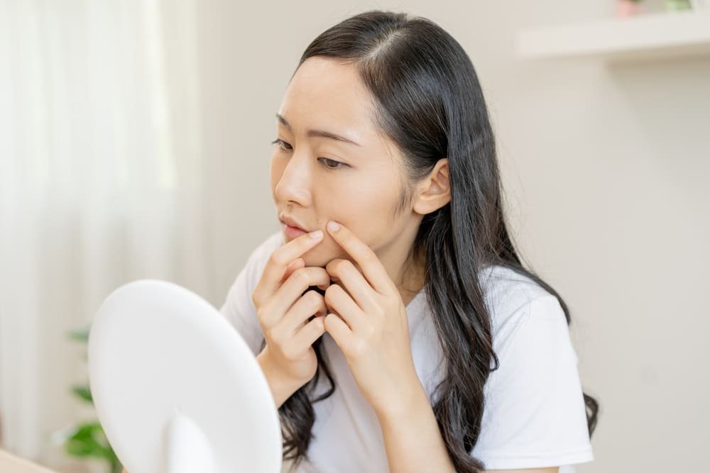 Apa Itu Jerawat Mendem: Penyebab, Ciri-Ciri, dan Cara Mengatasinya